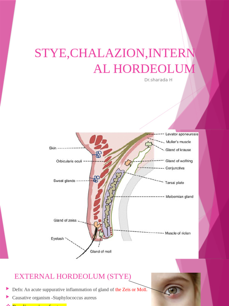 Styes, Chalazion, and Internal Hordeolum Guide | PDF | Clinical ...