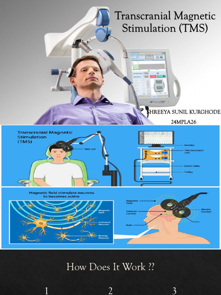 Transcranial Magnetic Stimulation (TMS) | PDF