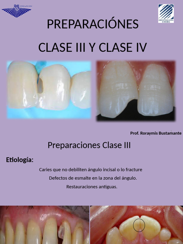Preparaciones Odontológicas Clase III y IV | PDF | Esmalte de dientes ...