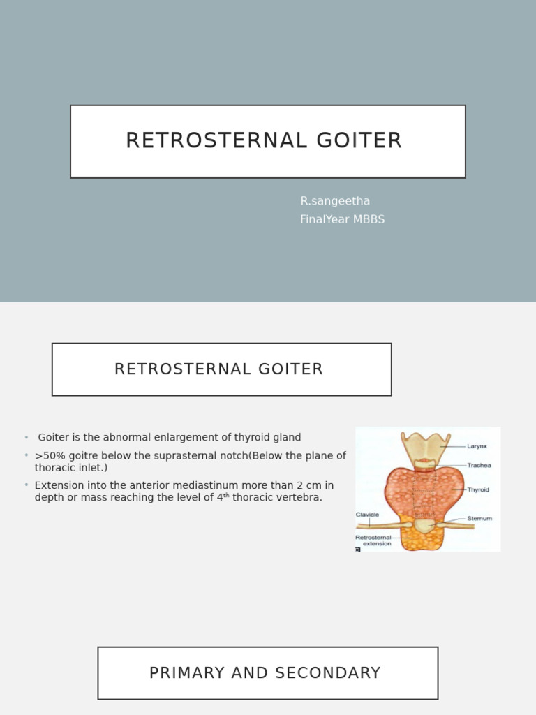 Retrosternal Goitre 2 | PDF