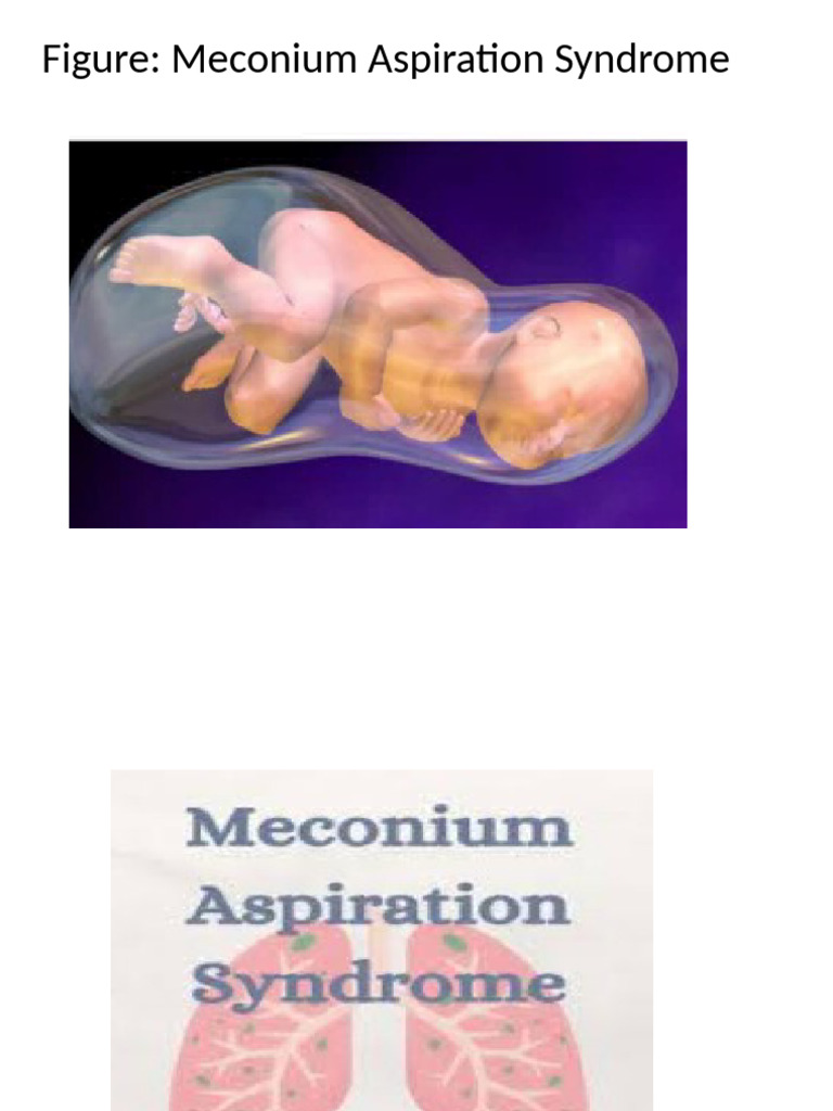 Meconium Aspiration Syndrome Overview | PDF | Diseases And Disorders ...