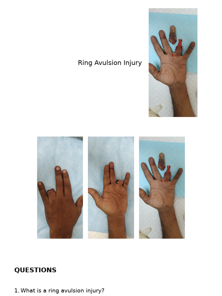 Ring Avulsion | PDF