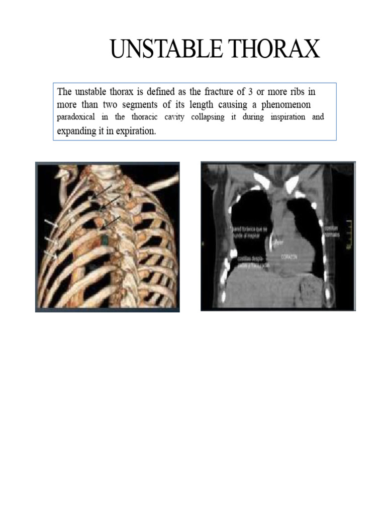 Unstable Thorax | PDF | Thorax | Lung
