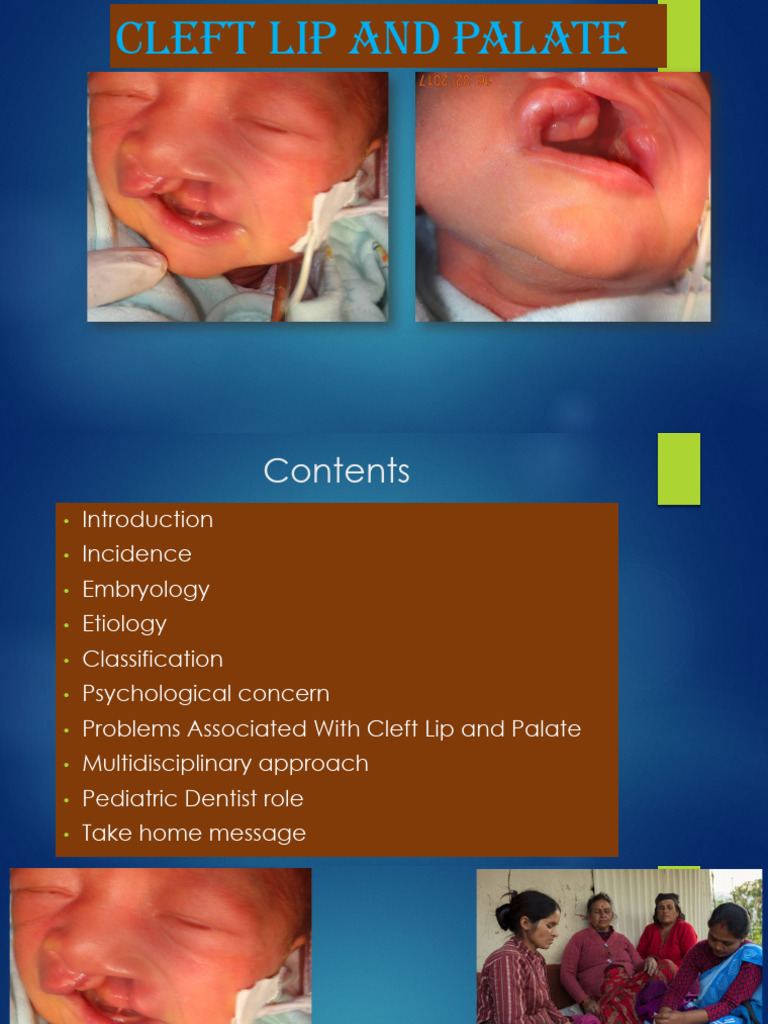Understanding Cleft Lip and Palate | PDF | Medical Specialties