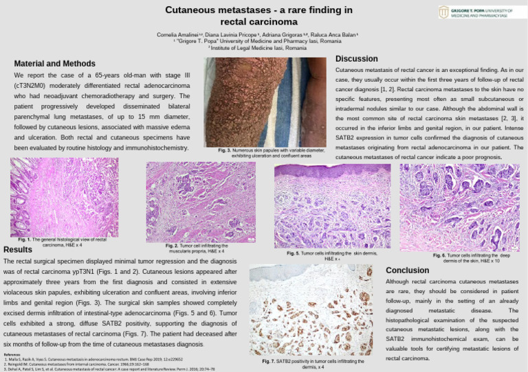 Metastaze Cutanate ESP 2024 FINAL | PDF | Metastasis | Carcinoma