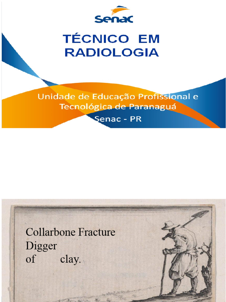 Understanding Clay Shoveler's Fracture | PDF