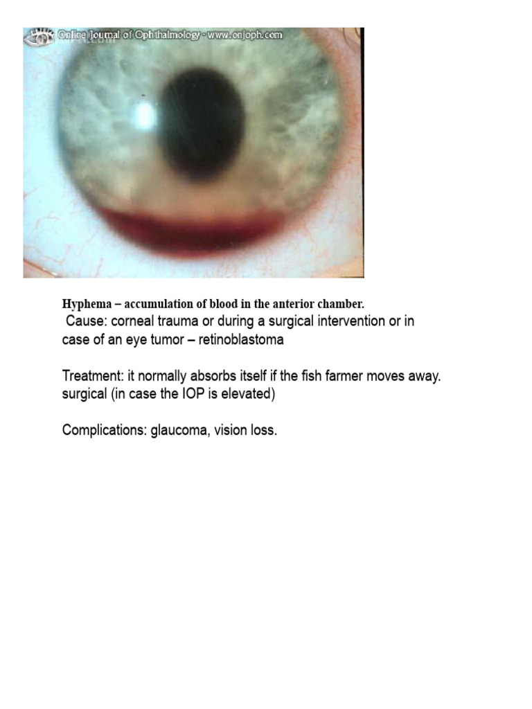 Eye Conditions: Hyphema, Ectropion, and More | PDF | Cataract | Cornea