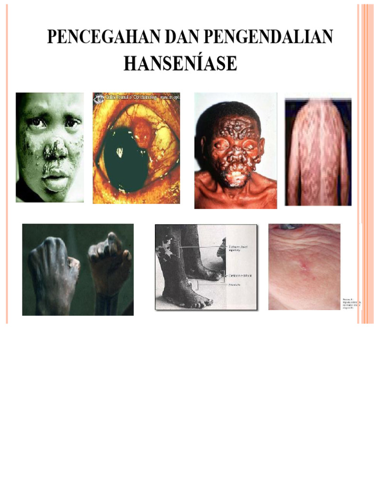 Pencegahan dan Pengendalian Hanseniasis | PDF