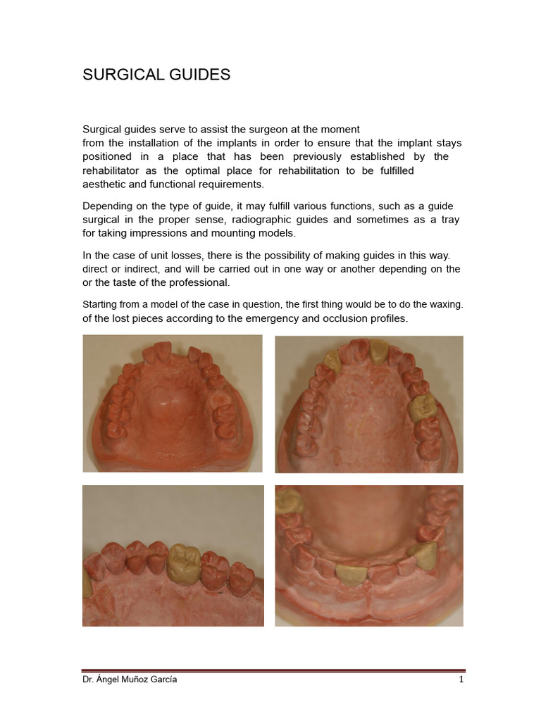 Surgical Guides, Implantology | PDF | Dental Implant | Prosthesis