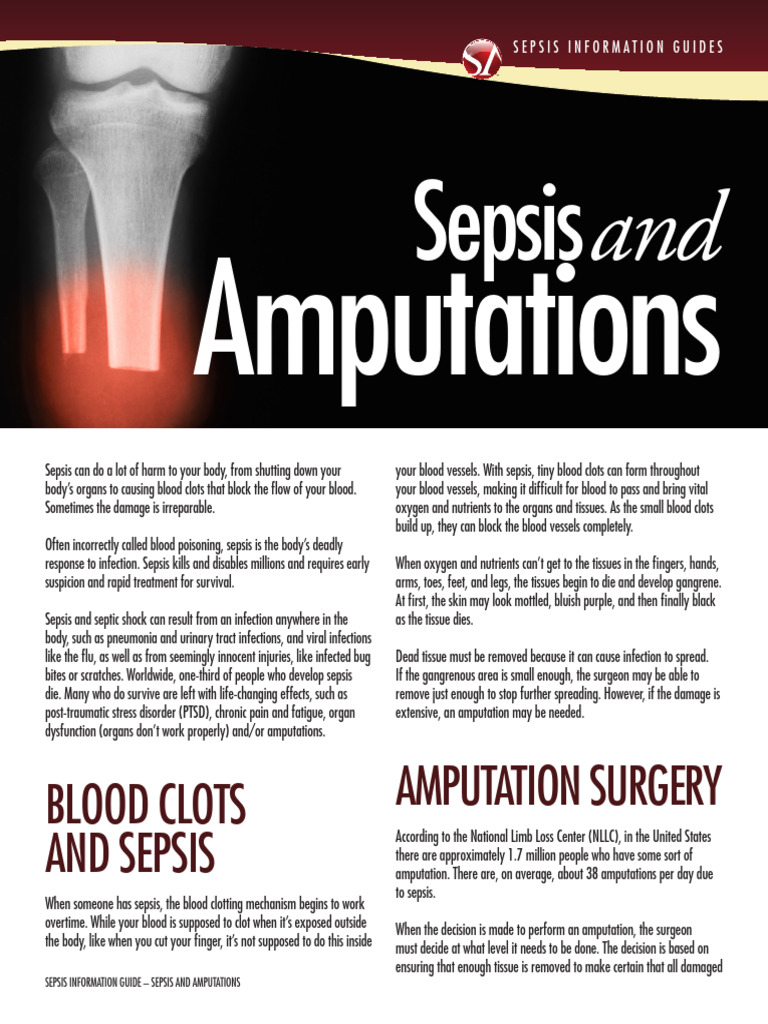 Sepsis Amputations | PDF | Sepsis | Amputation