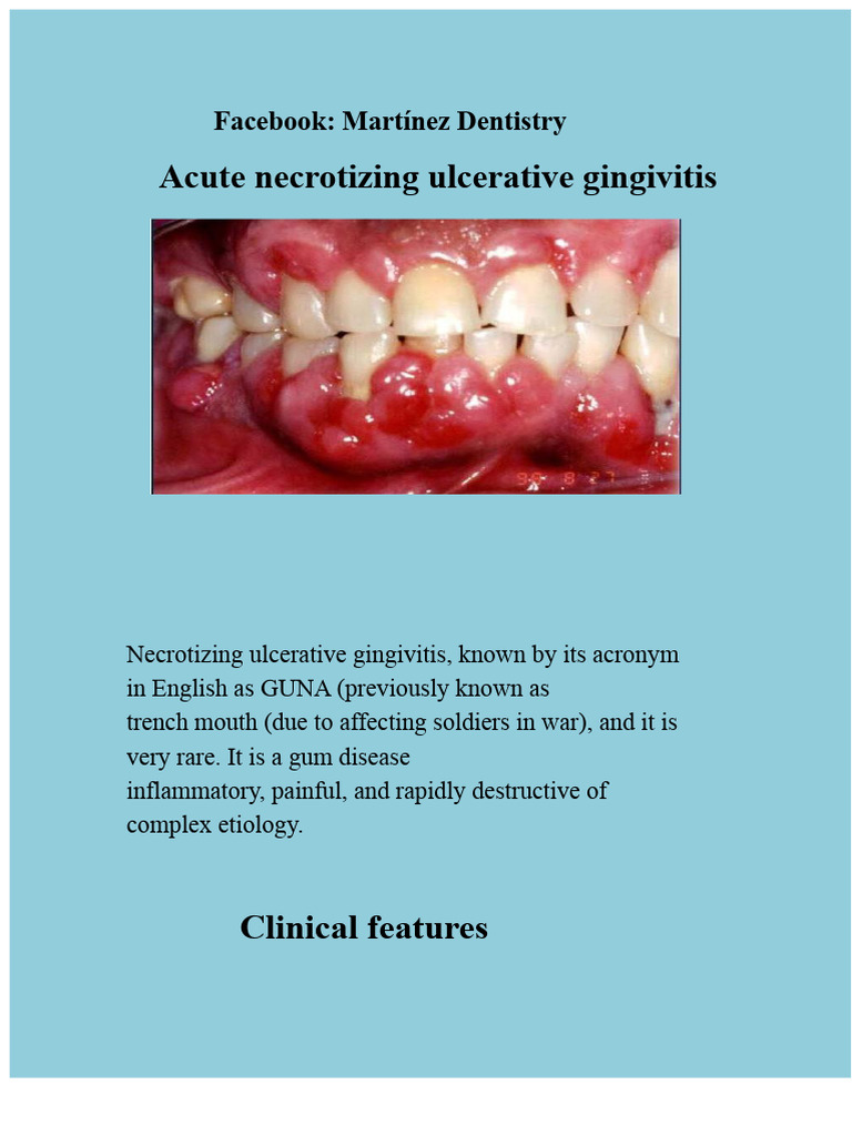 Acute Necrotizing Ulcerative Gingivitis | PDF