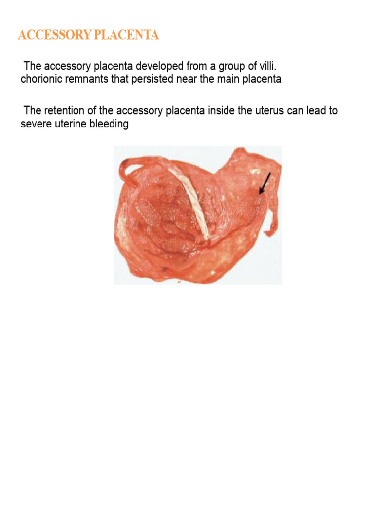 placental anomalies.pptx | PDF | Placenta | Uterus