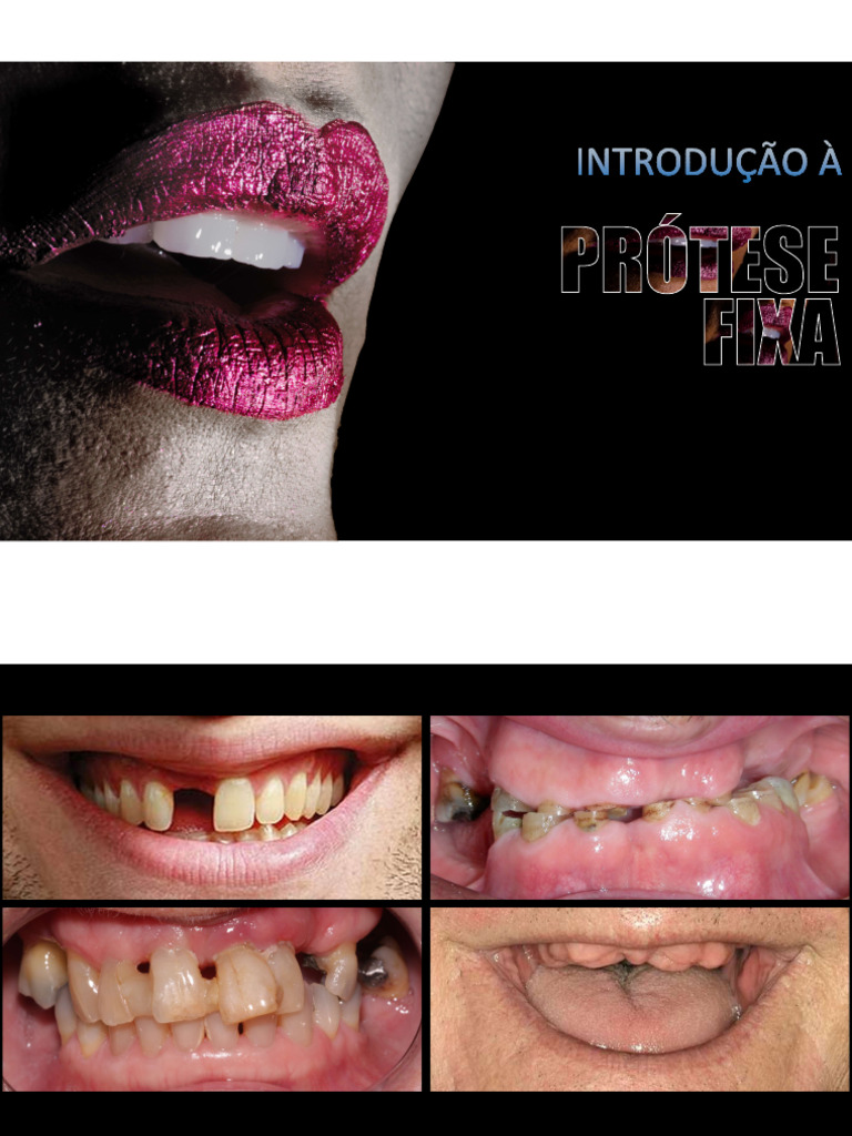 AULA 1 - Introdução ao Estudo da Prótese Fixa pptx | PDF | Dente humano