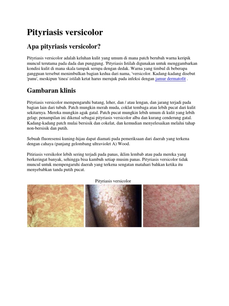 Pityriasis Versicolor 1 | PDF
