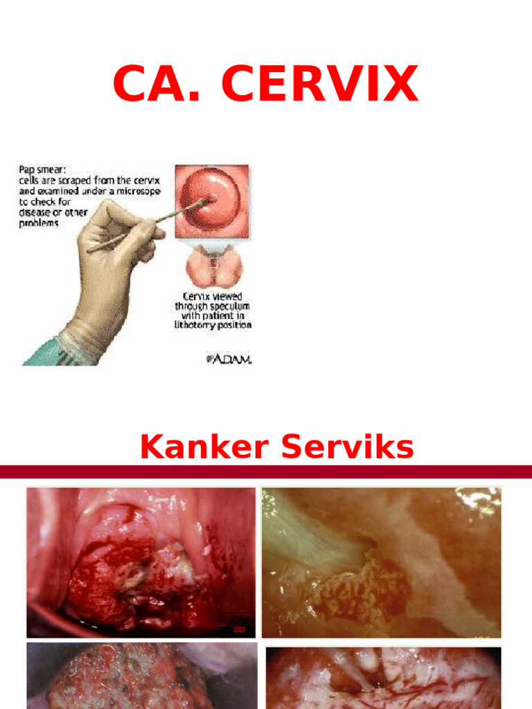 Ca_cervix | PDF