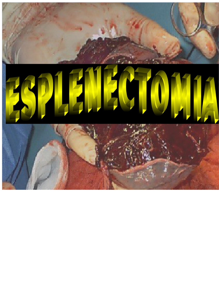S02 Splenectomy | PDF | Spleen | Surgical Suture