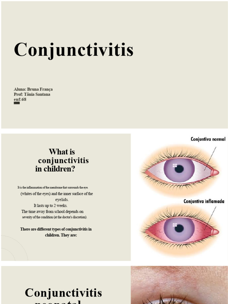 Conjunctivitis | PDF | Diseases And Disorders | Medical Specialties
