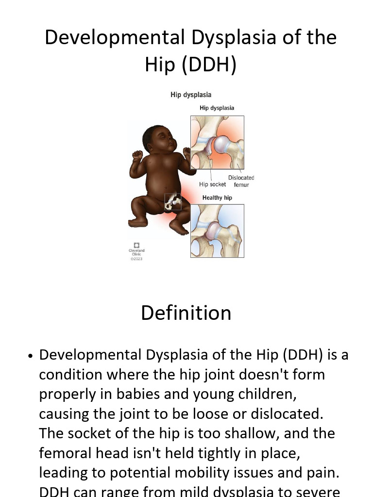 Understanding Developmental Dysplasia of the Hip | PDF