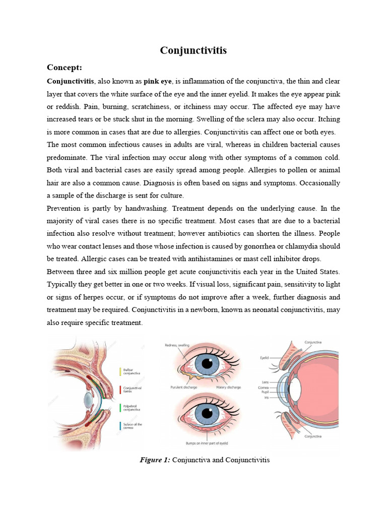Understanding Conjunctivitis: Causes & Treatment | PDF | Immunology ...