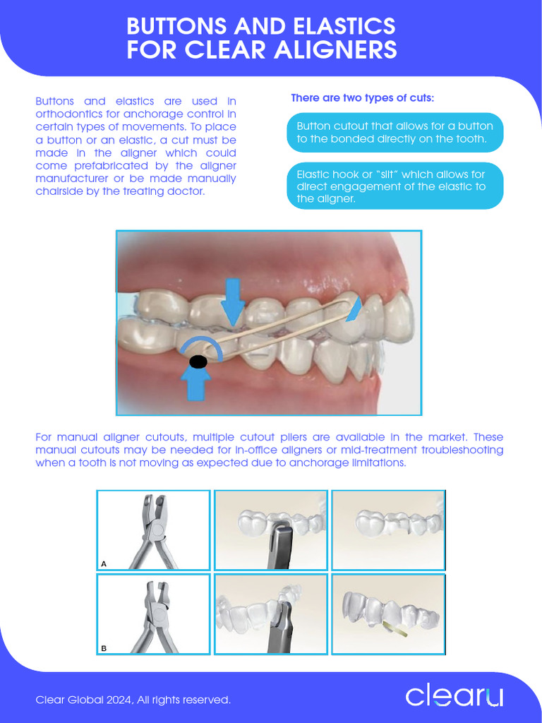 Buttons and Elastics for Clear Aligners | PDF | Tooth | Dentistry