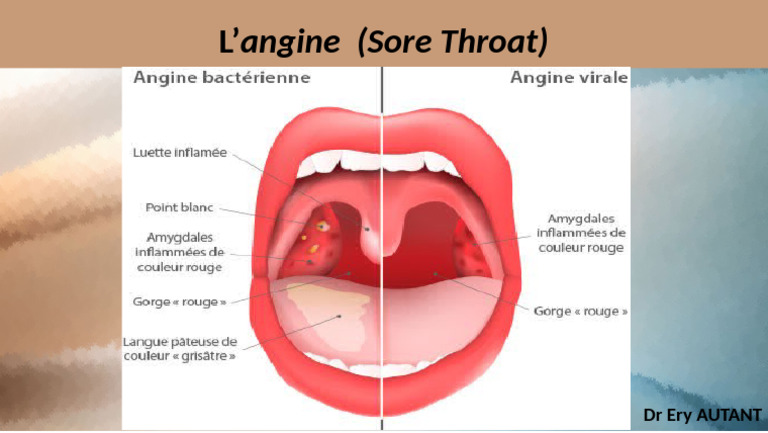 Angine de La Gorge Image | PDF