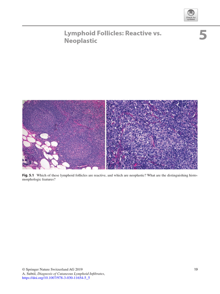 limfoid follicles, reactive vs neoplastic | PDF | Lymph Node | Immunology
