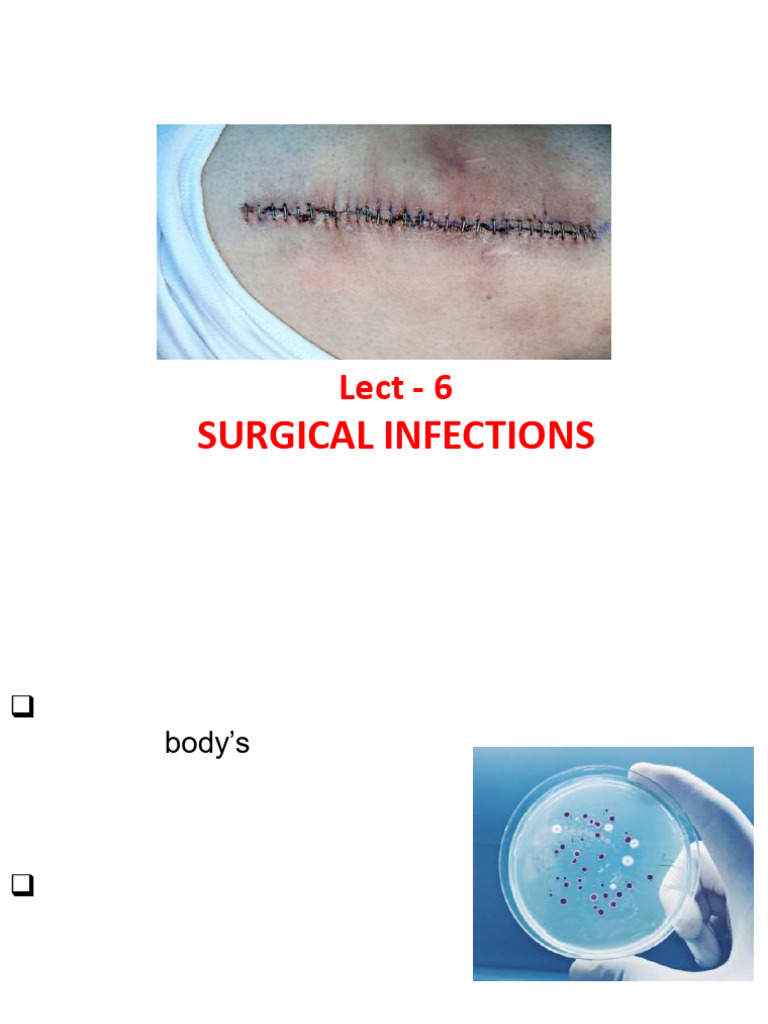 Understanding Surgical Infections | PDF | Immune System | Infection