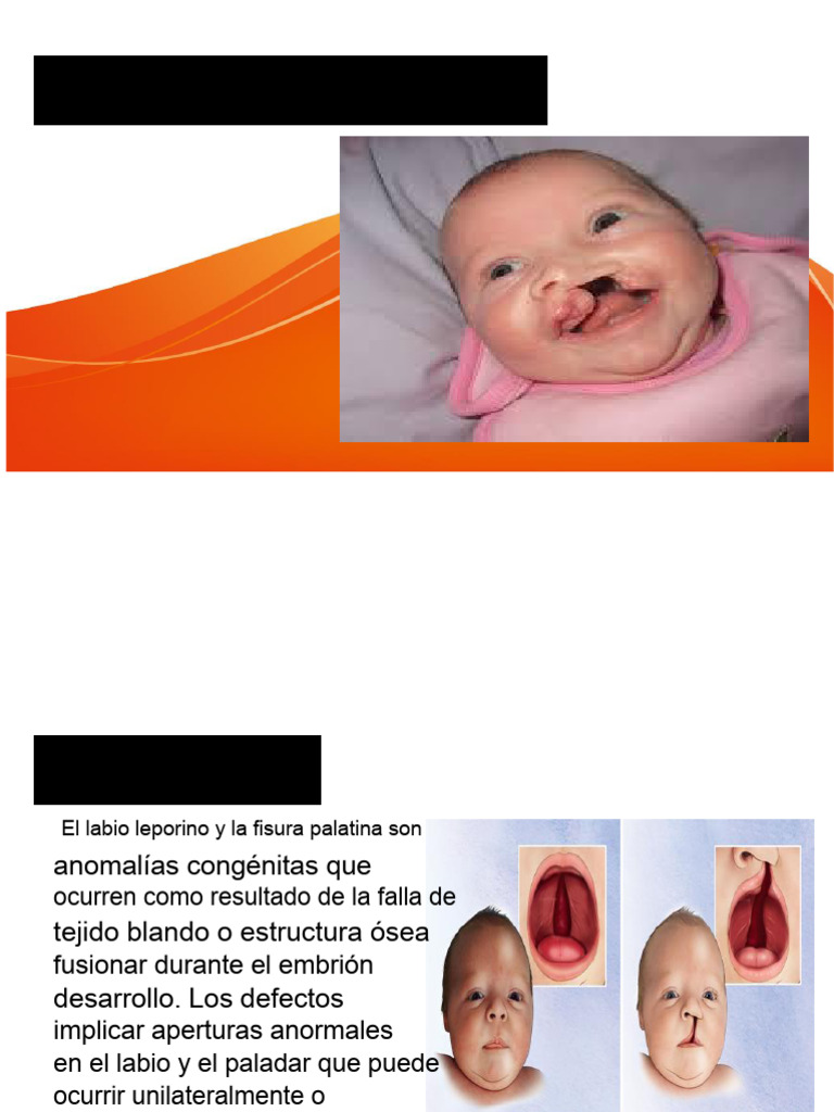 Labio Leporino y Paladar Hendido | PDF | Especialidades Medicas ...