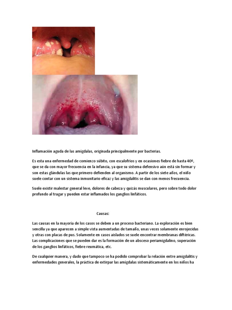 Inflamación Aguda de Las Amígdalas | PDF | Enfermedades y trastornos ...