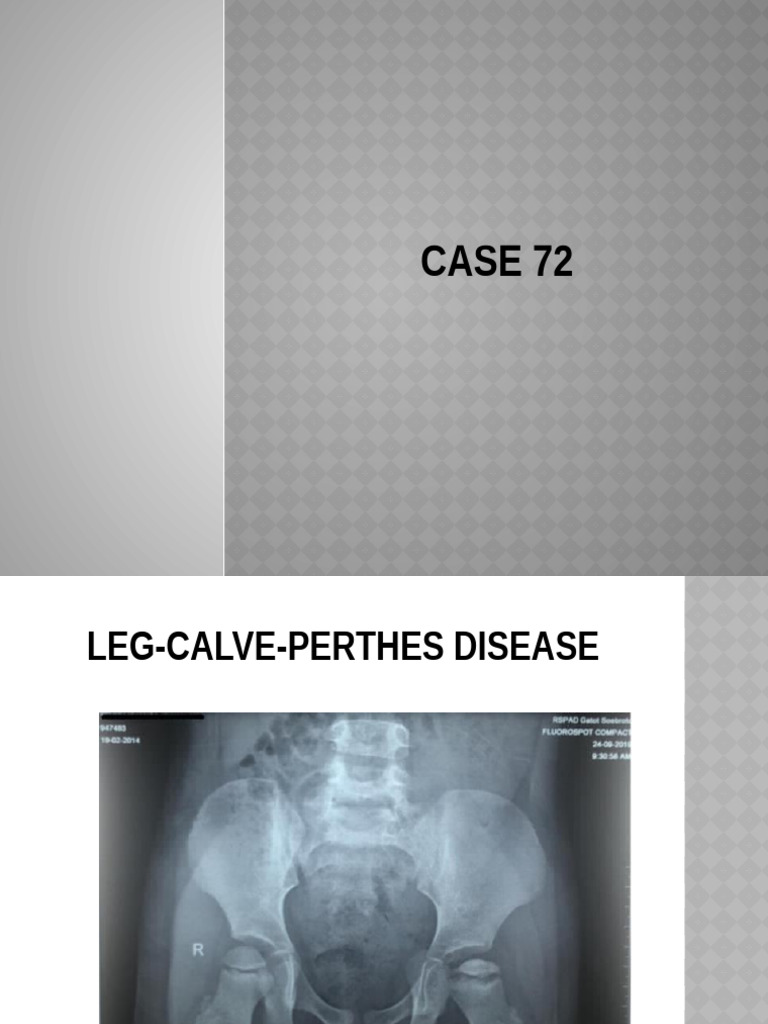 Understanding Legg-Calvé-Perthes Disease | PDF | Diseases And Disorders ...