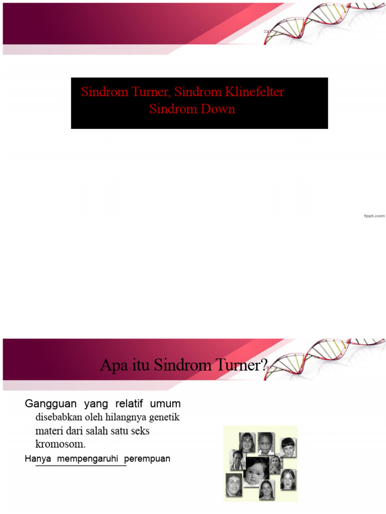 Gejala dan Diagnosis Sindrom Turner dan Down | PDF