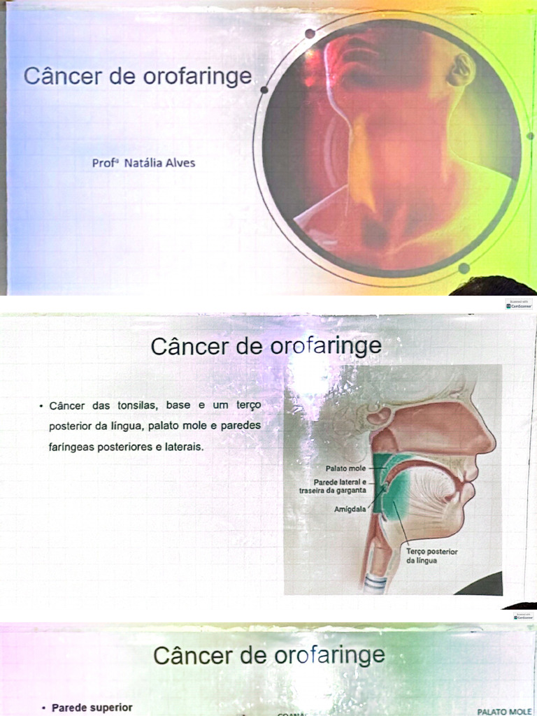 CA de Orofaringe 05.11.25 | PDF