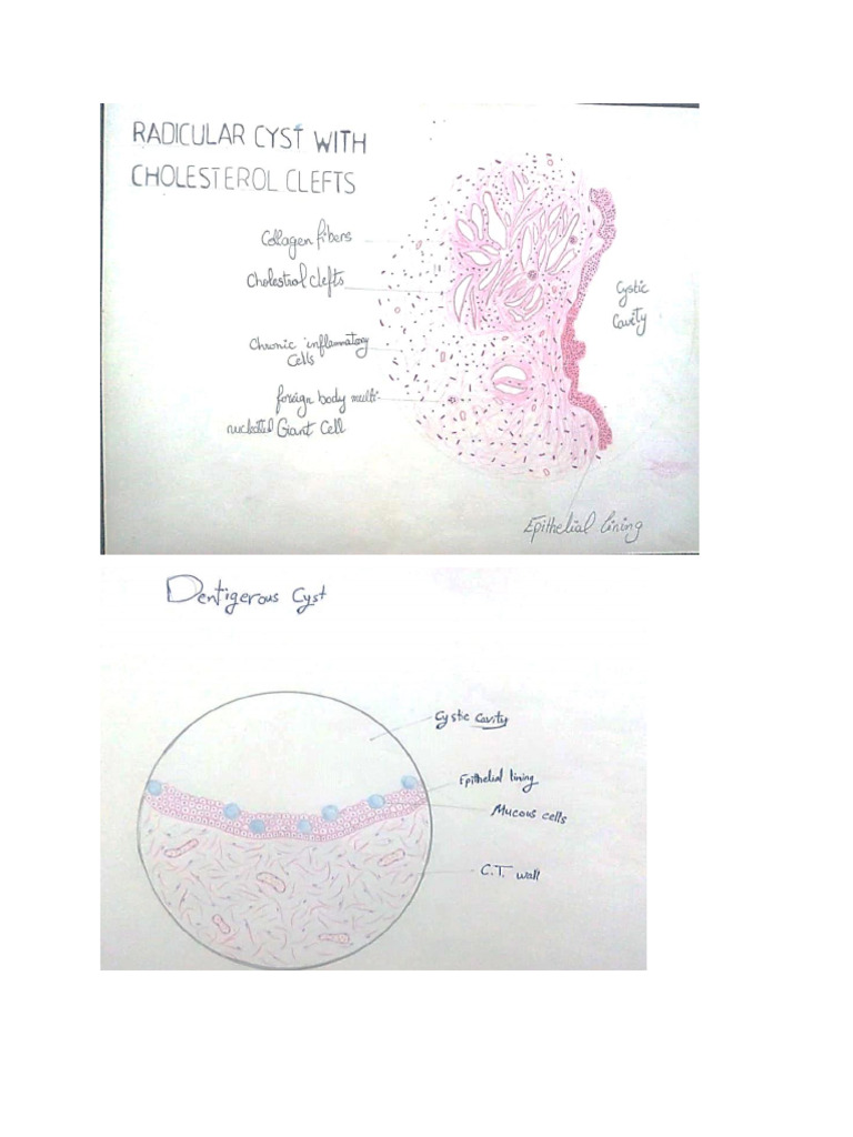 Cyst Drawings | PDF