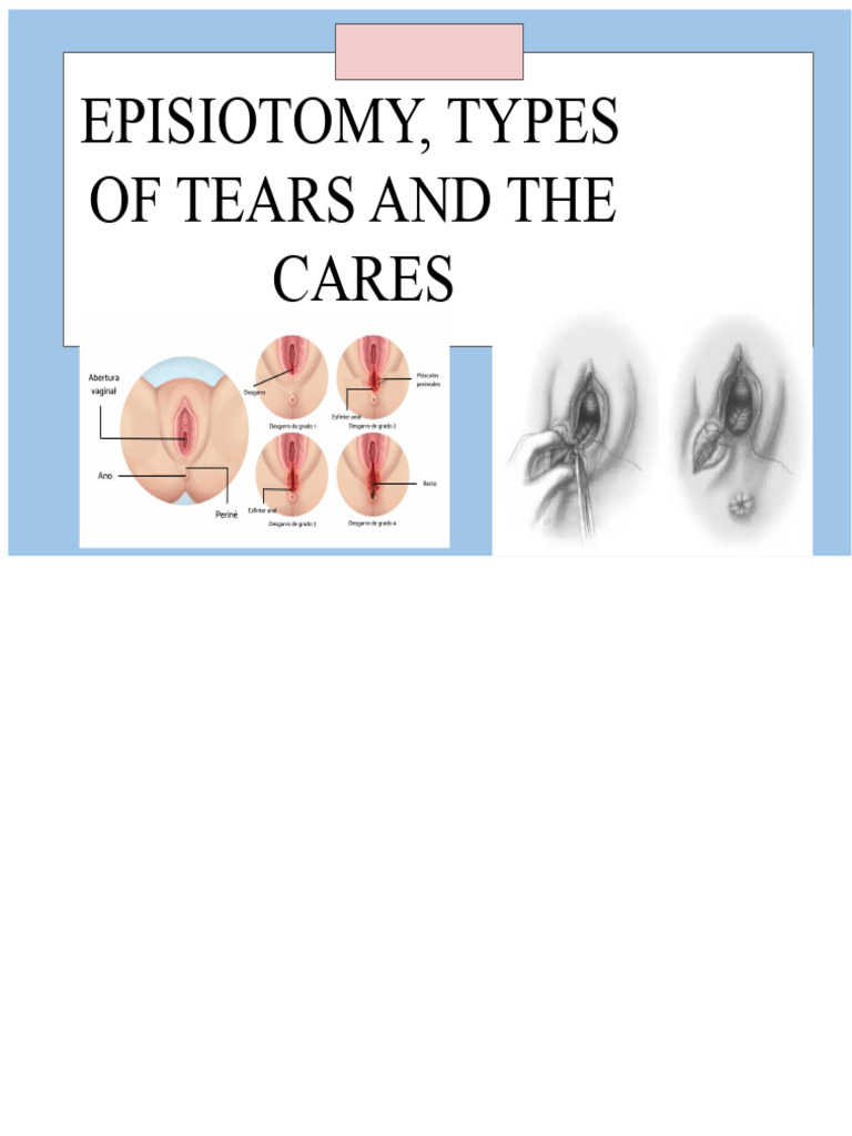 Episiotomy, Types of Tear, and Care | PDF