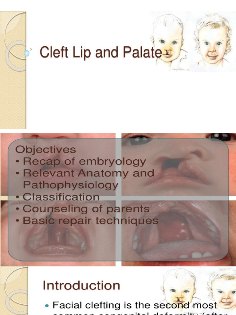 Cleft Lip & Palate | PDF