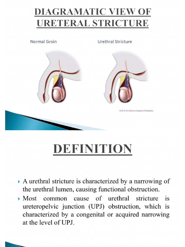 Urethral Strictures-Final 251204 092459 | PDF