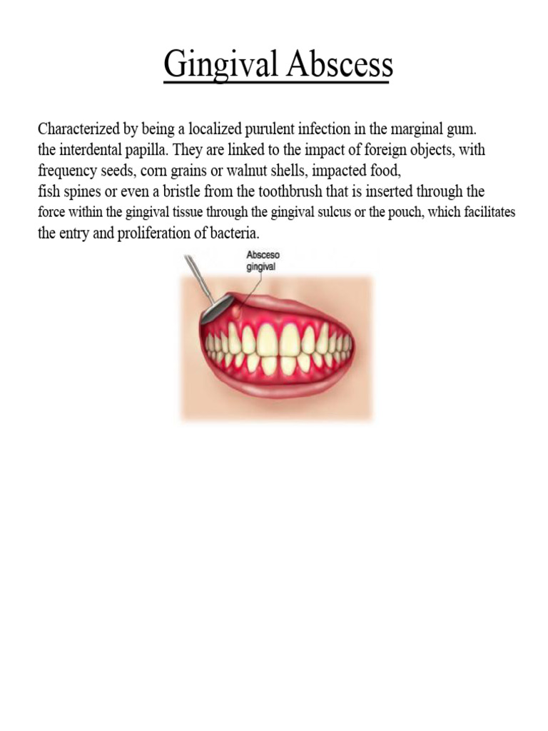 Gingival Abscess | PDF | Periodontology | Medical Specialties
