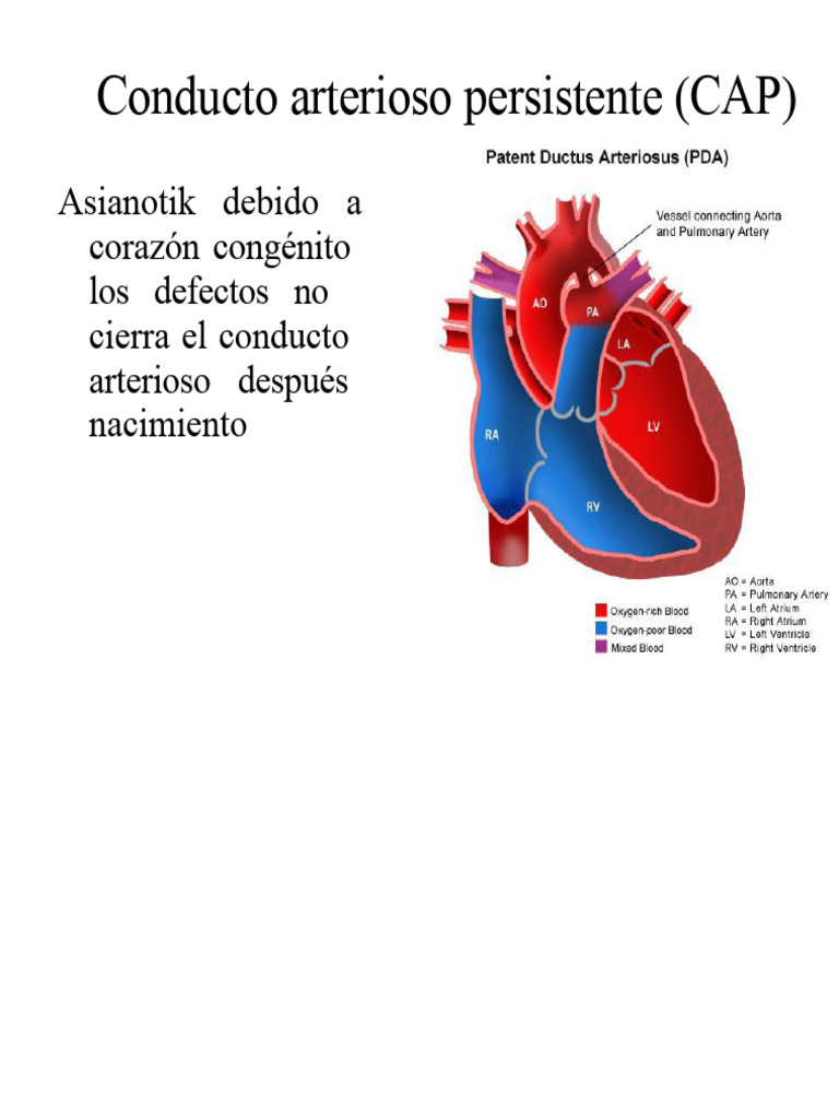 Conducto Arterioso Persistente: Causas y Tratamientos | PDF | Defecto ...