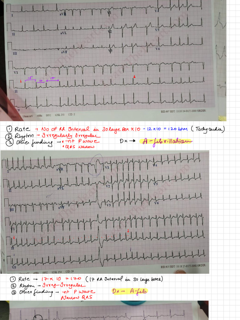 Ecg - Vikrant (Ruhs’18) | PDF | Electrophysiology | Cardiovascular Diseases