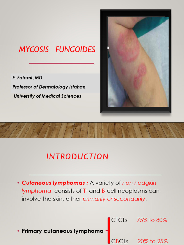 Mycosis Fungiodes, Cutaneous Lymphoma | PDF | Lymphoma | Medical ...