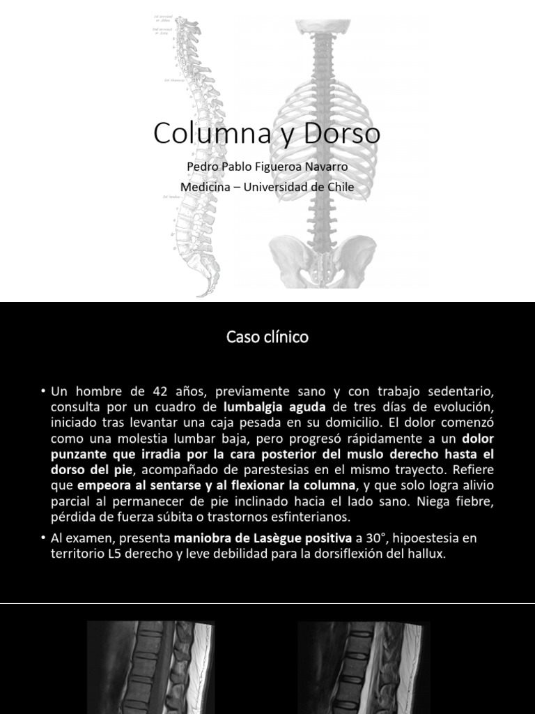 Lumbalgia Aguda: Caso Clínico y Diagnóstico | PDF