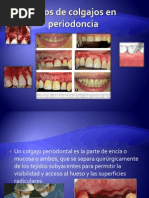 Clasificación de Seibert Los Defectos Del Reborde Alveolar | PDF