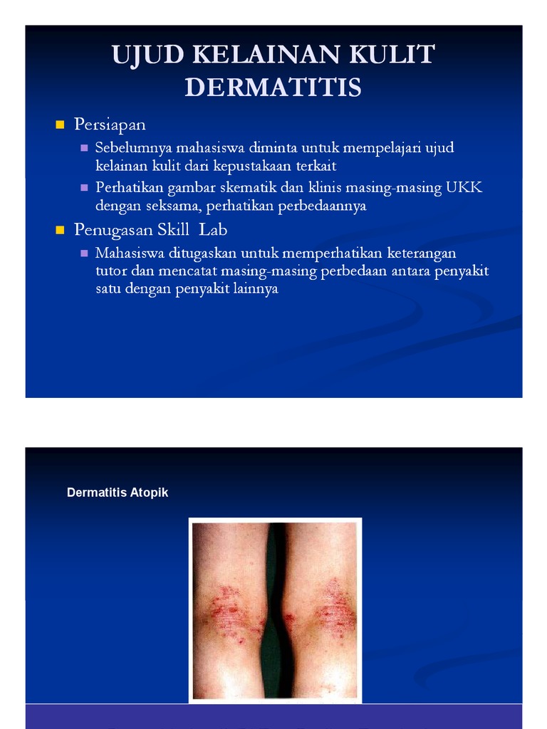 Tatalaksana Dermatitis Venenata | PDF
