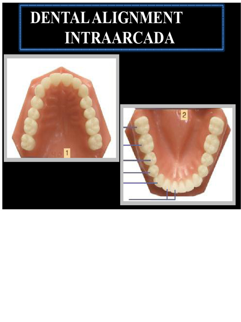 Intraarch Dental Alignment | PDF