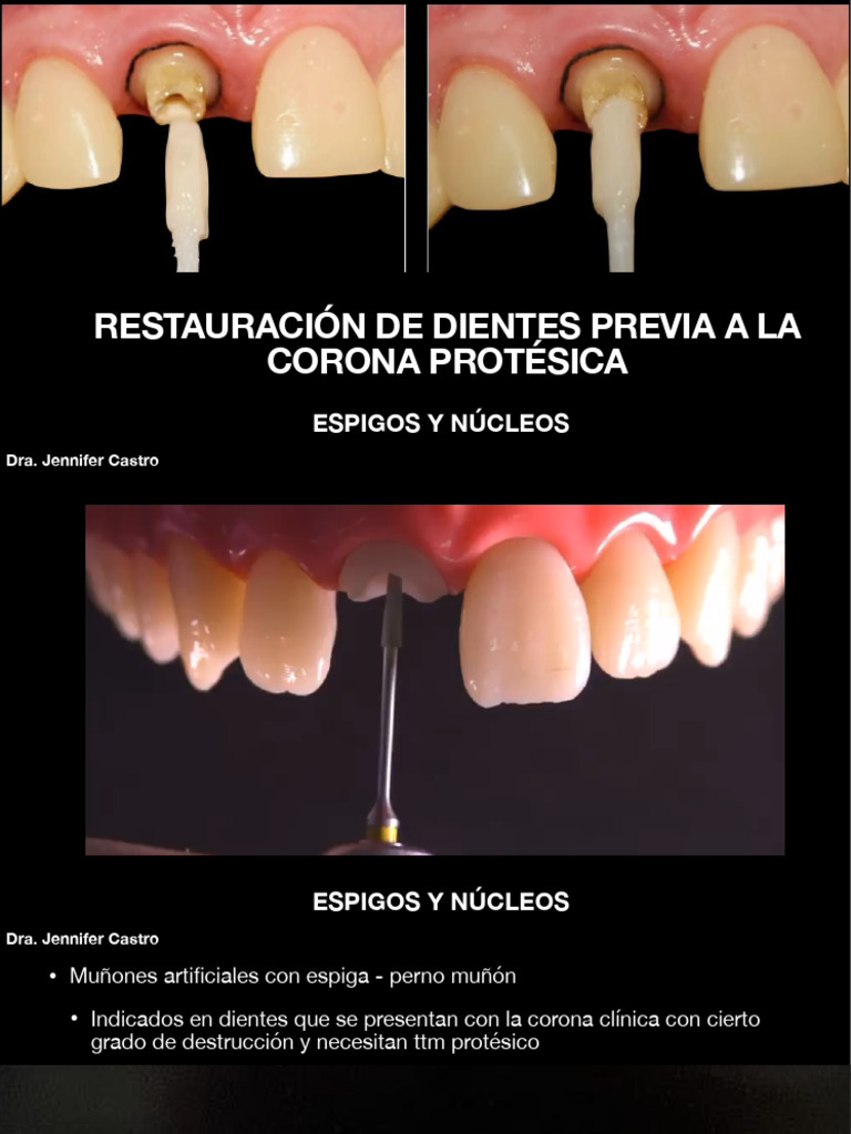 Restauración Dental: Espigos y Núcleos | PDF | Aleación | Diente