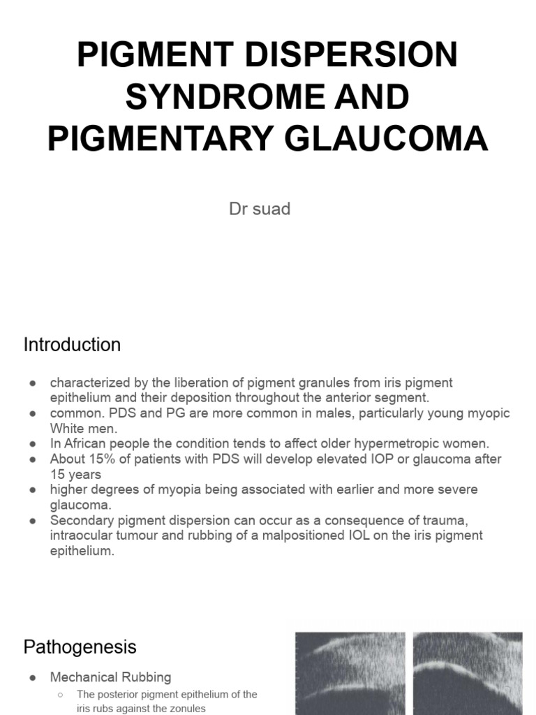 Pigment Dispersion Syndrome and Pigmentary Glaucoma | PDF | Glaucoma ...