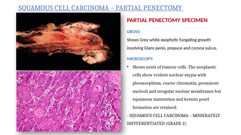 Squamous Cell Carcinoma - Partial Penectomy | PDF
