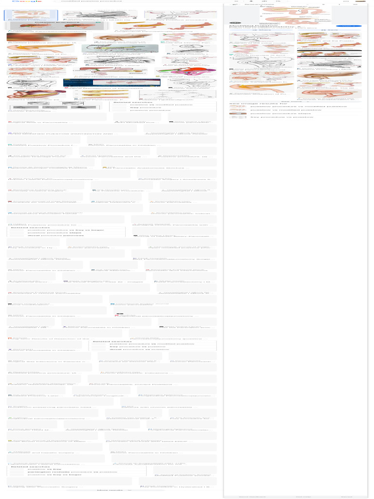 Modified Puestow Procedure - Google Search | PDF | Gastroenterology ...