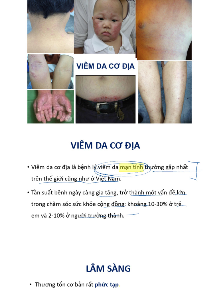 Viêm Da Cơ Địa | PDF