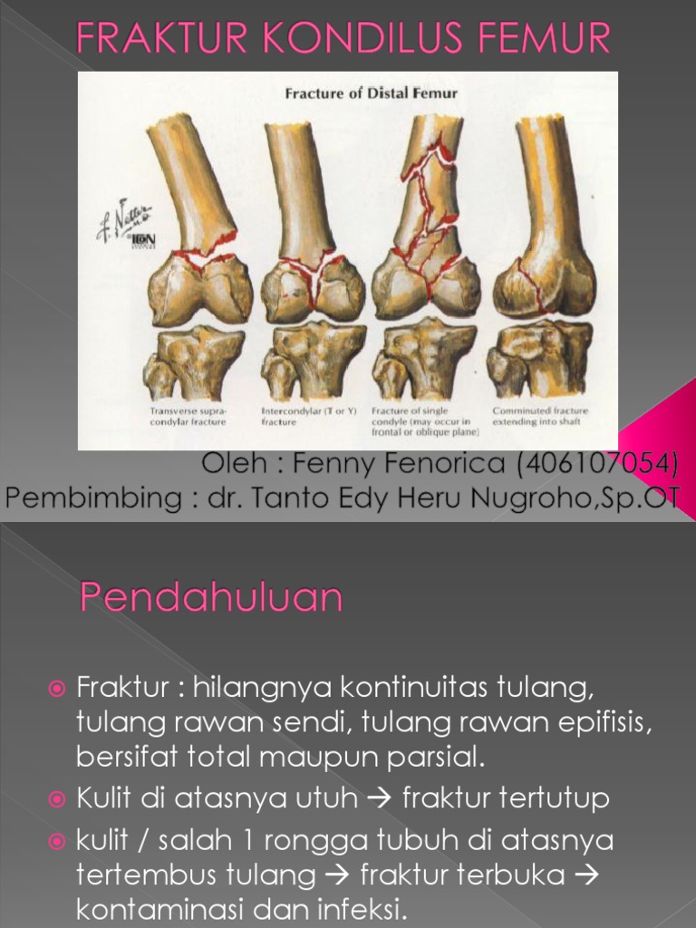 Presentasi Fraktur Condilus Femur | PDF